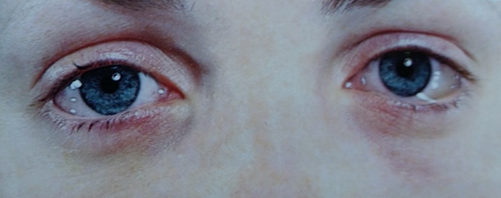 Blue Skies, Red Eyes: Oak Pollen on the Rise | Asthma Center